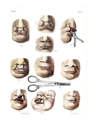 Surgery to Repair Cleft Lip Composition Notebook: Wide Ruled Note ...
